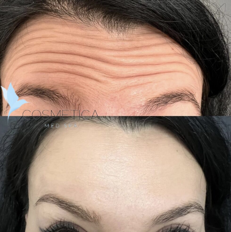 Best Botox Injections in Boca Raton, FL: Cosmetica Med Spa - Cosmetica